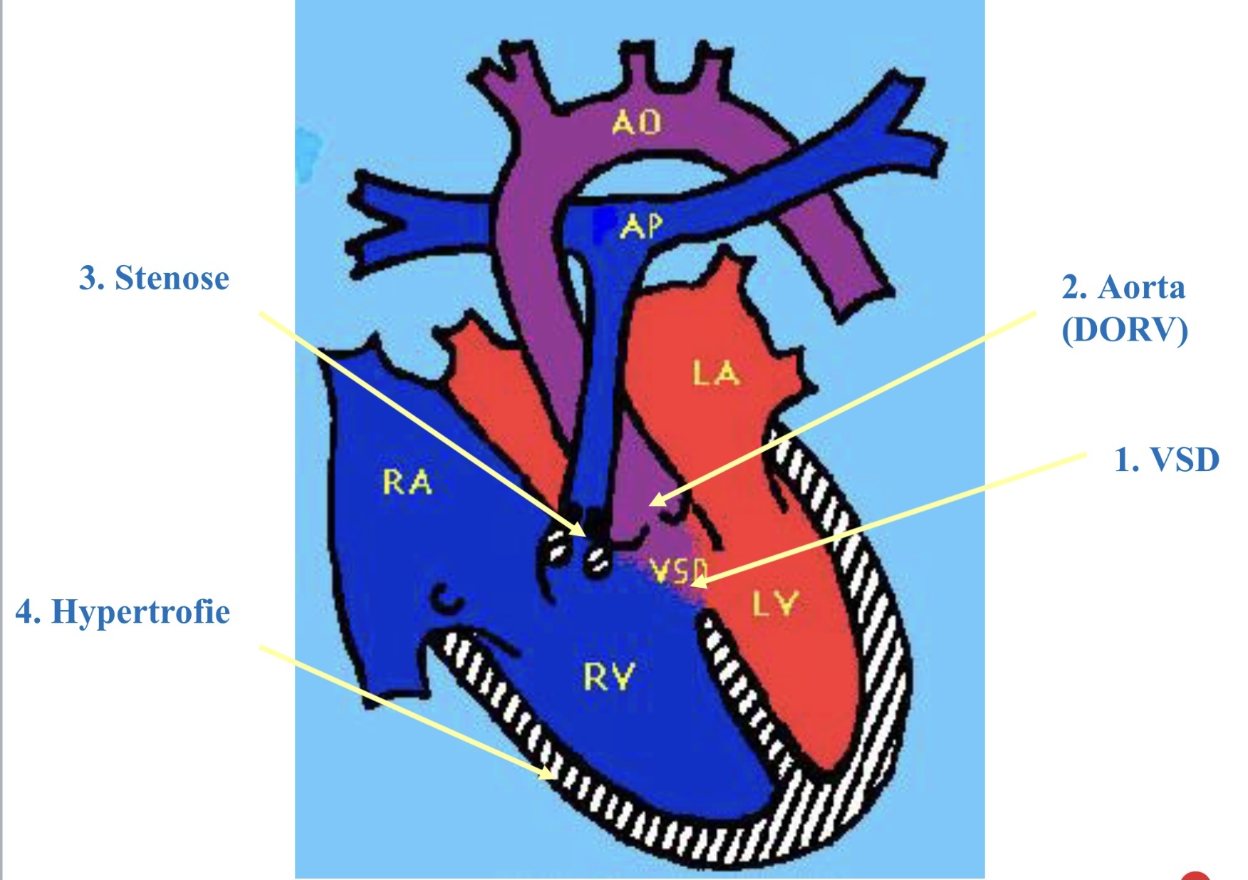 Tetralogie van Fallot – Een hart uit de duizend